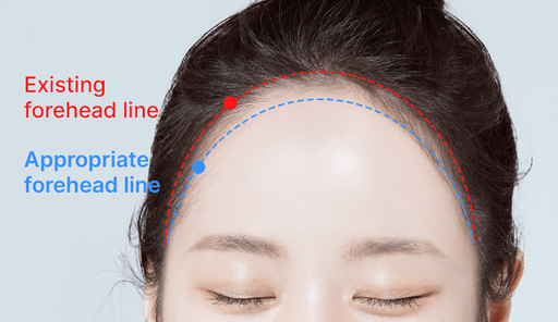 Forehead Reduction | AB Plastic Surgery