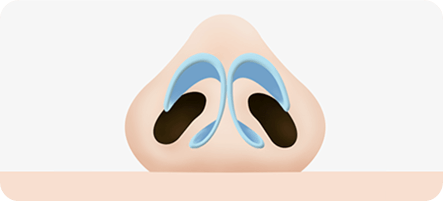 Bulbous Nose Rhinoplasty | Nose job | AB Plastic Surgery