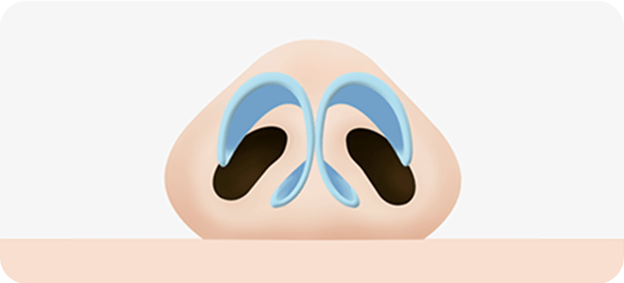 Bulbous Nose Rhinoplasty | Nose job | AB Plastic Surgery