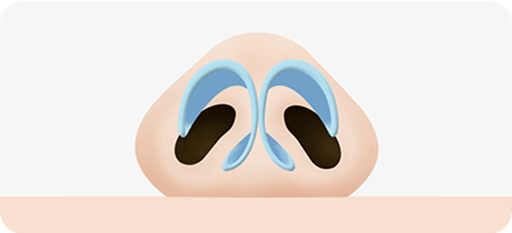 Bulbous Nose Rhinoplasty | Nose job | AB Plastic Surgery