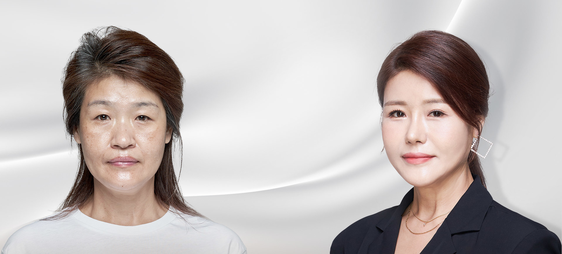 Anti-aging | AB Lifting - Plastic Surgery Korea
