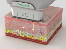 Soft Tissue Contouring | Facial Contouring | AB Plastic Surgery Korea