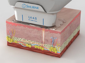 Soft Tissue Contouring | Facial Contouring | AB Plastic Surgery Korea