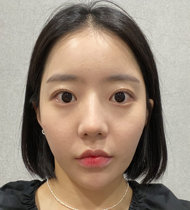 Square Jaw Reduction Surgery | Facial Contouring | AB Plastic Surgery Korea