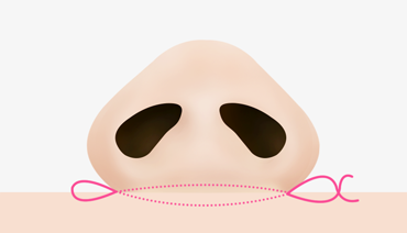 Alar Resection | Nose |【AB plastic surgery】