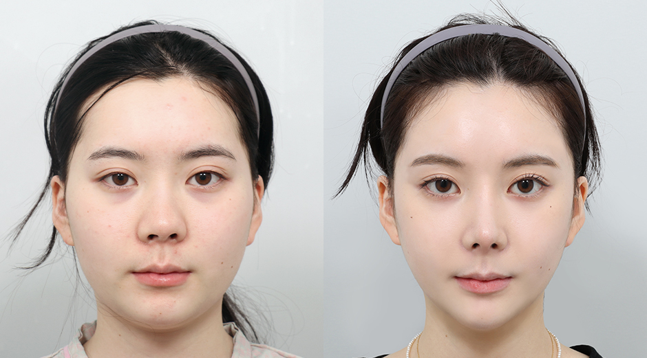 Square Jaw Reduction Surgery | Facial Contouring | AB Plastic Surgery Korea