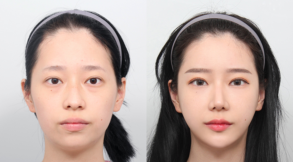 Cheekbone Reduction Surgery | AB Plastic Surgery