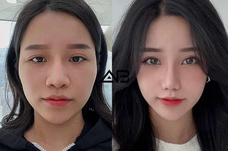 Korean Plastic Surgery: The Art of Facial Contouring | AB Plastic ...