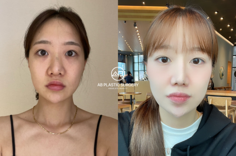 Korean Nose Surgery Techniques: Essential Facts and Information | AB ...