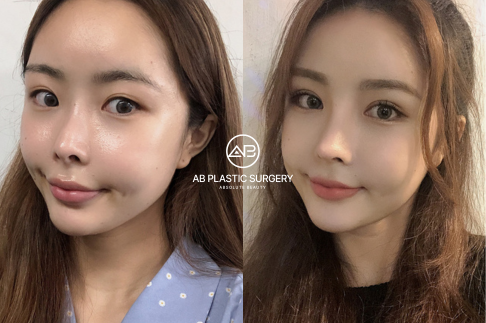 Plastic Surgery in Korea 2024: A Step-by-Step Guide | AB Plastic ...