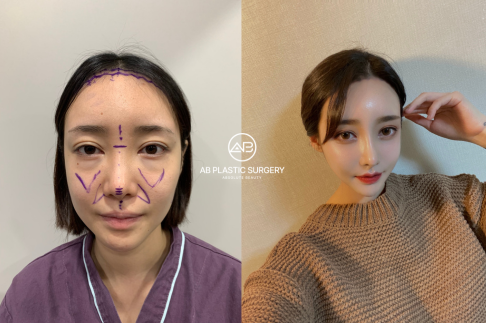 Lowering the Hairline: Forehead Reduction Surgery in Korea Explained ...