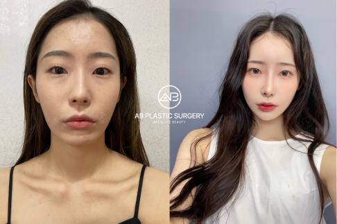 Plastic Surgery for Foreigners in Korea: What Questions You Should Ask ...