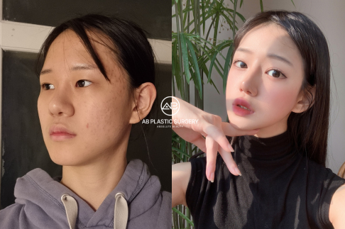 Bulbous Nose Rhinoplasty: Methods, Costs, and Recovery Time