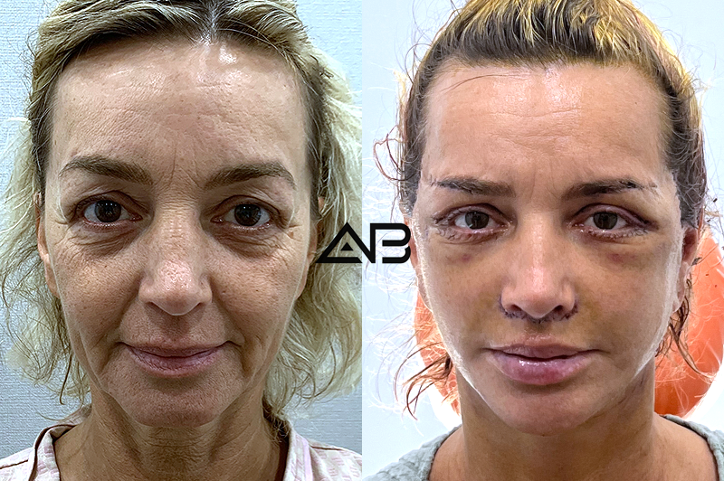 4 Reasons Why You Should Choose Endotine Implants for Face Lifting | AB ...