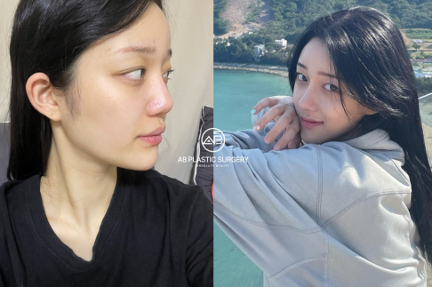 Flat Nose Concerns: How Rhinoplasty Can Help