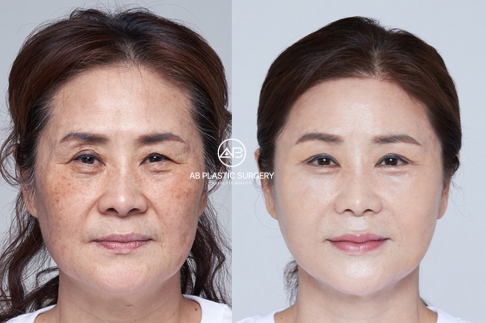 Forehead Thread Lifting in Korea: What Foreign Patients Need to Know ...