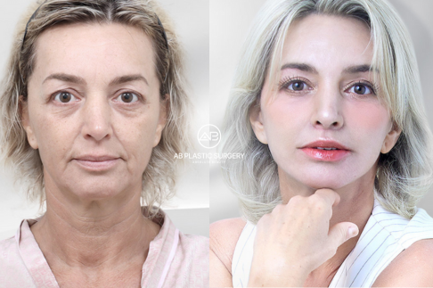 Essential FAQs on Plastic Surgery in Korea for Foreign Patients