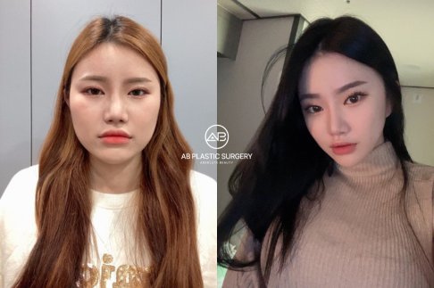 Top 6 Non-Surgical Solutions for Narrowing a Wide Face | AB Plastic ...