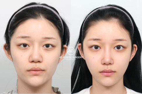 Korean actresses plastic surgery store
