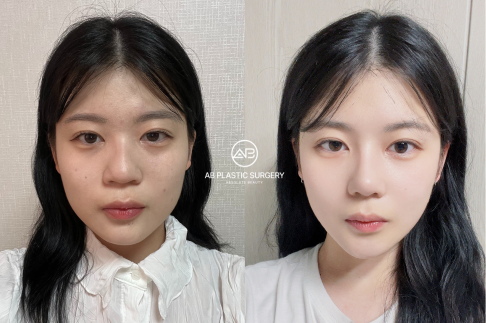 v plastic surgery daegu