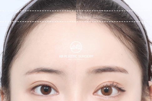 7 Reasons Why Korea Leads the World in Forehead Reduction Surgery | AB ...