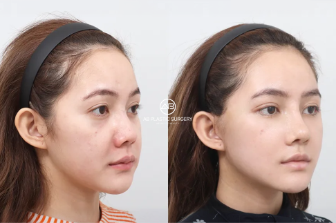 Ozempic Face Explained: Why Rapid Weight Loss Ages the Face and How ...