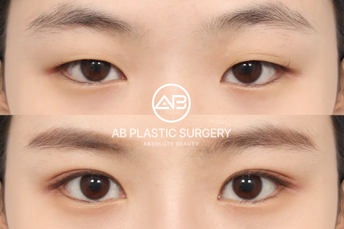 Double Eyelid Surgery in Korea: How to Choose the Right Method and ...