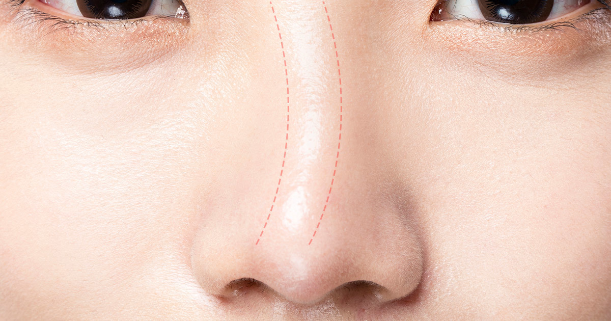 Crooked nose, can rhinoplasty truly correct it?