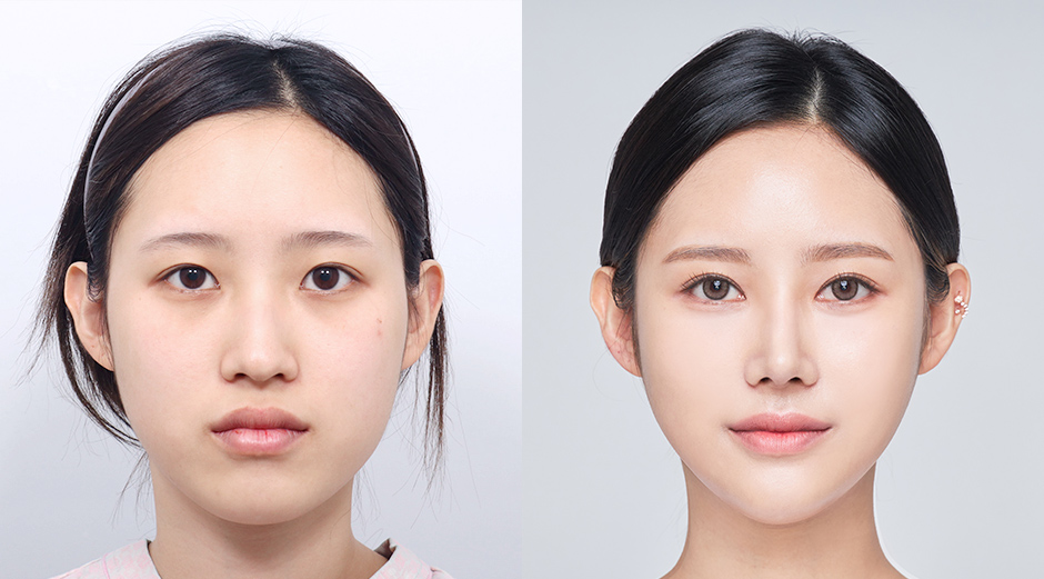 Korea Plastic Surgery Before and After AB Plastic Surgery
