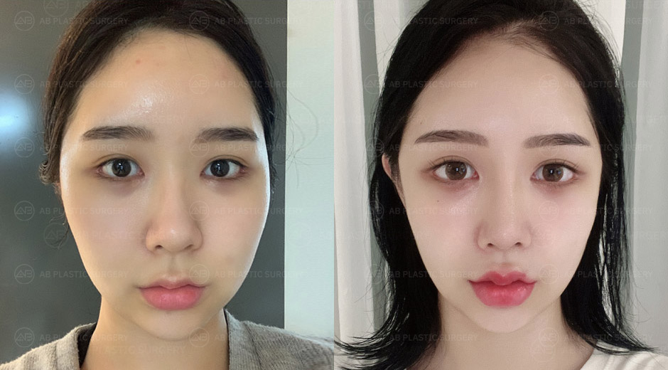I was worried about sagging skin after contouring surgery, but I didn't ...