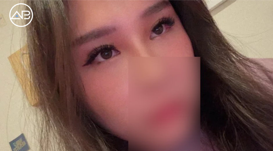 Transformative Experience: My Brow Lift and Lower Lateral Canthoplasty ...